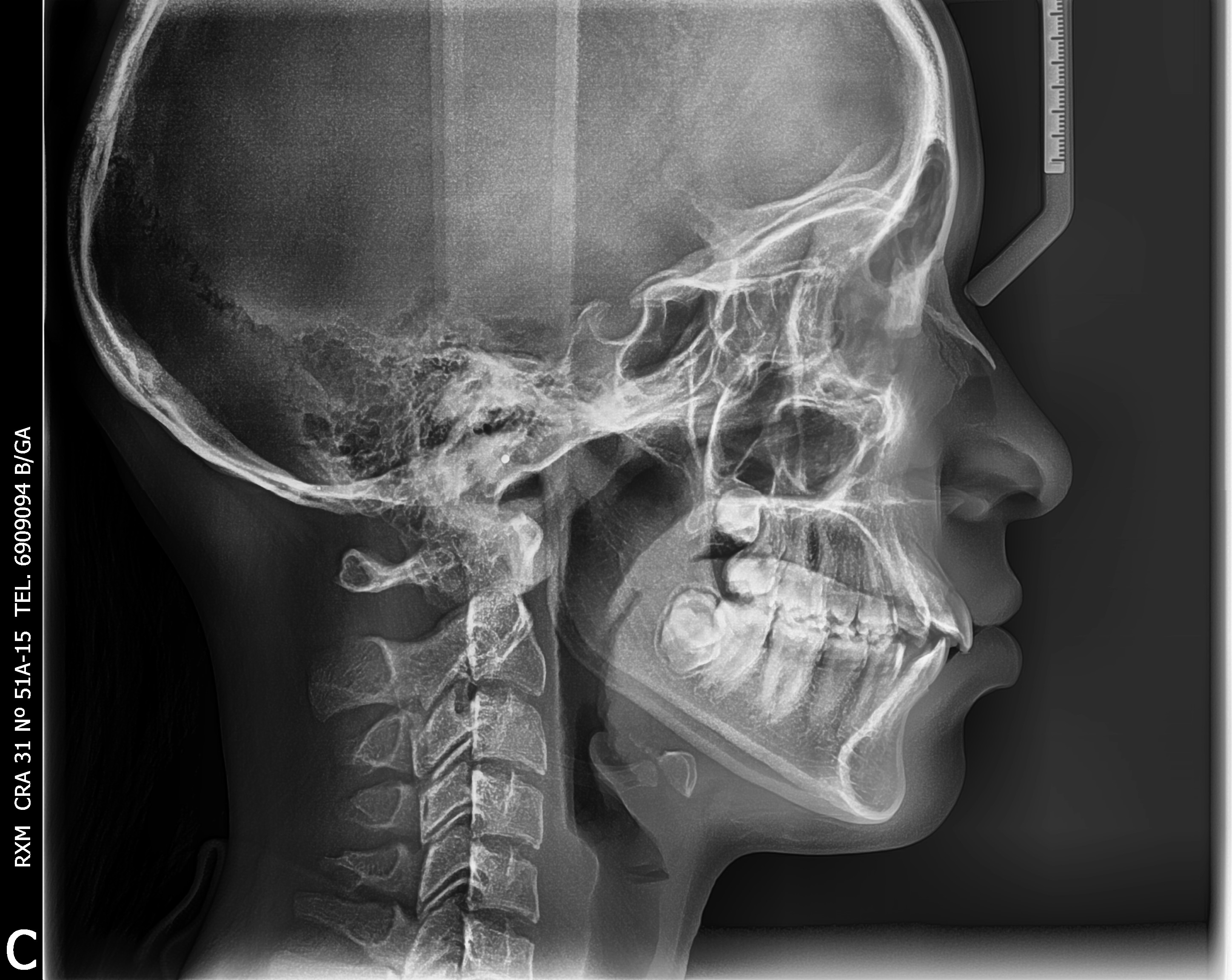 Radiografías Extraorales – RXM Radiologia Maxilofacial Radiografías Extraorales – RXM Radiologia Maxilofacial