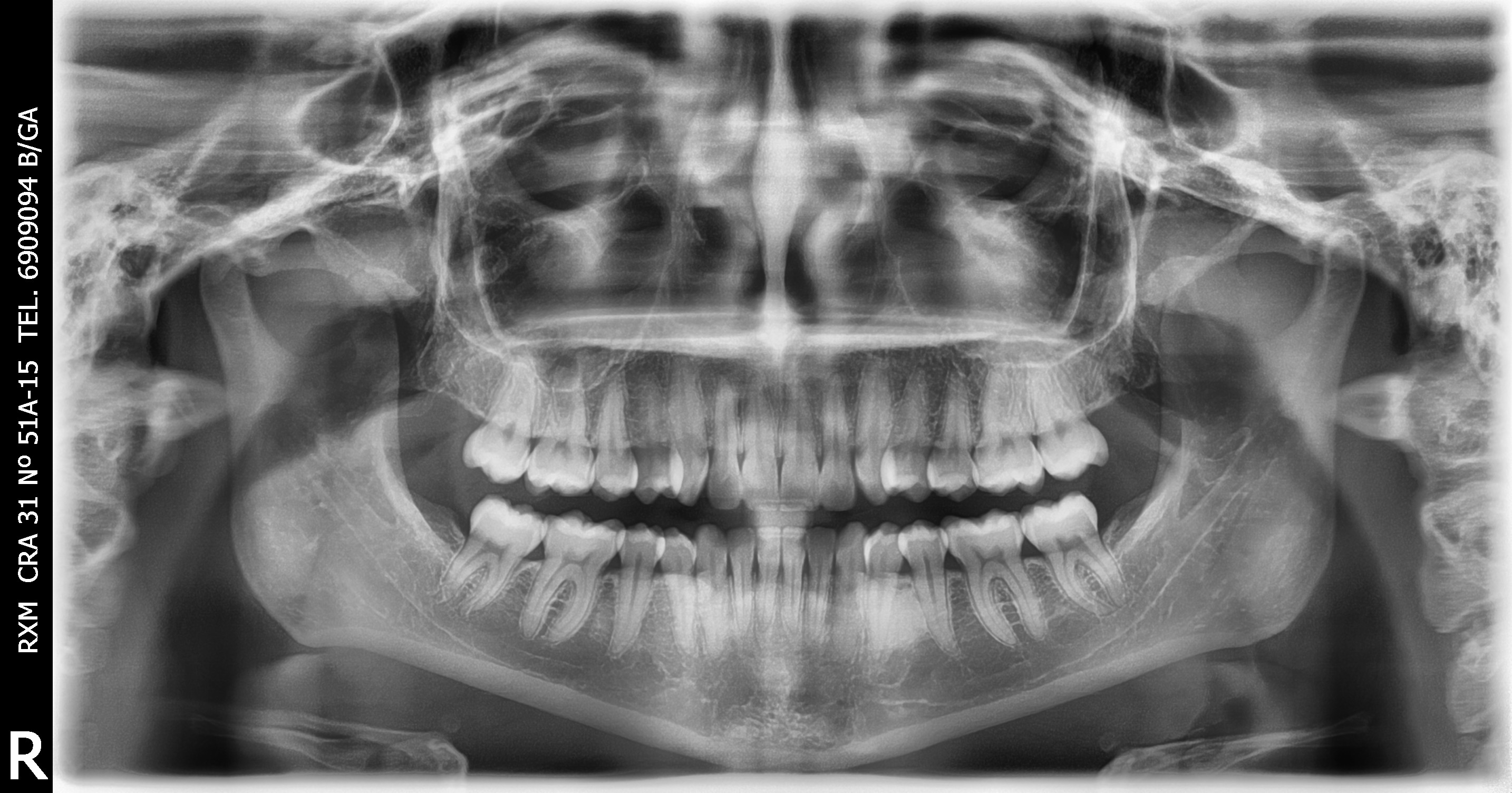 Radiografías Extraorales Rxm Radiologia Maxilofacial